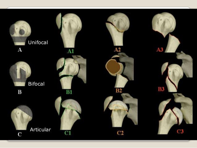 Fracturas de húmero manejo conservador