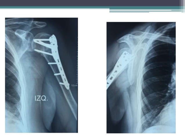 Fractura de hombro, lesión de hombro, operación de hombro | PPT