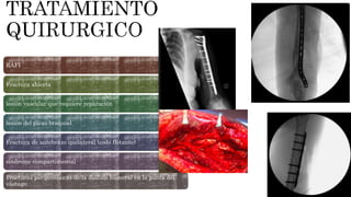 FRACTURAS DE HUMERO DIAFISARIO Y PROXIMAL | PPTX