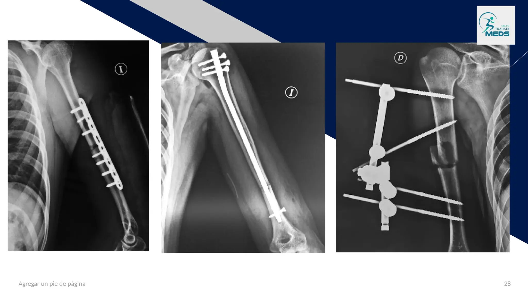 Fracturas de Humero proximal distal y diafisiario | PPTX