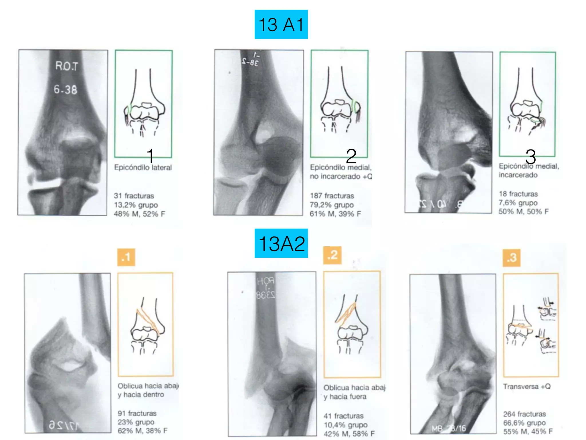Fracturas de humero distal | KEY | Death, Injury, or Military Conflict ...