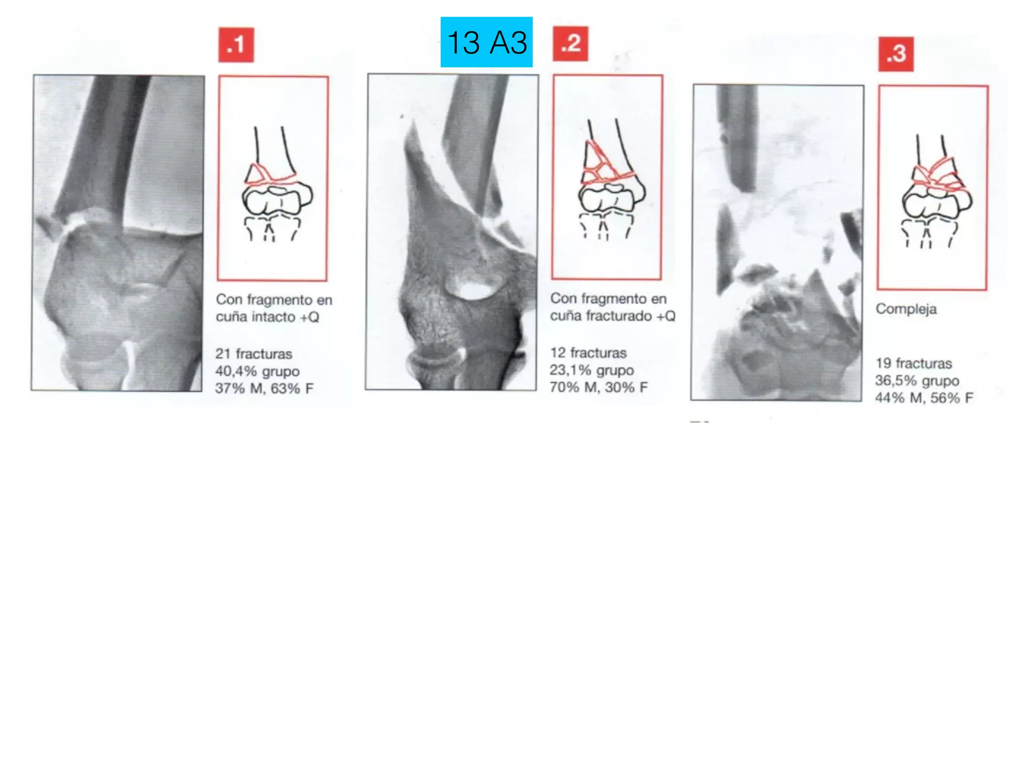 Fracturas de humero distal | KEY | Death, Injury, or Military Conflict ...