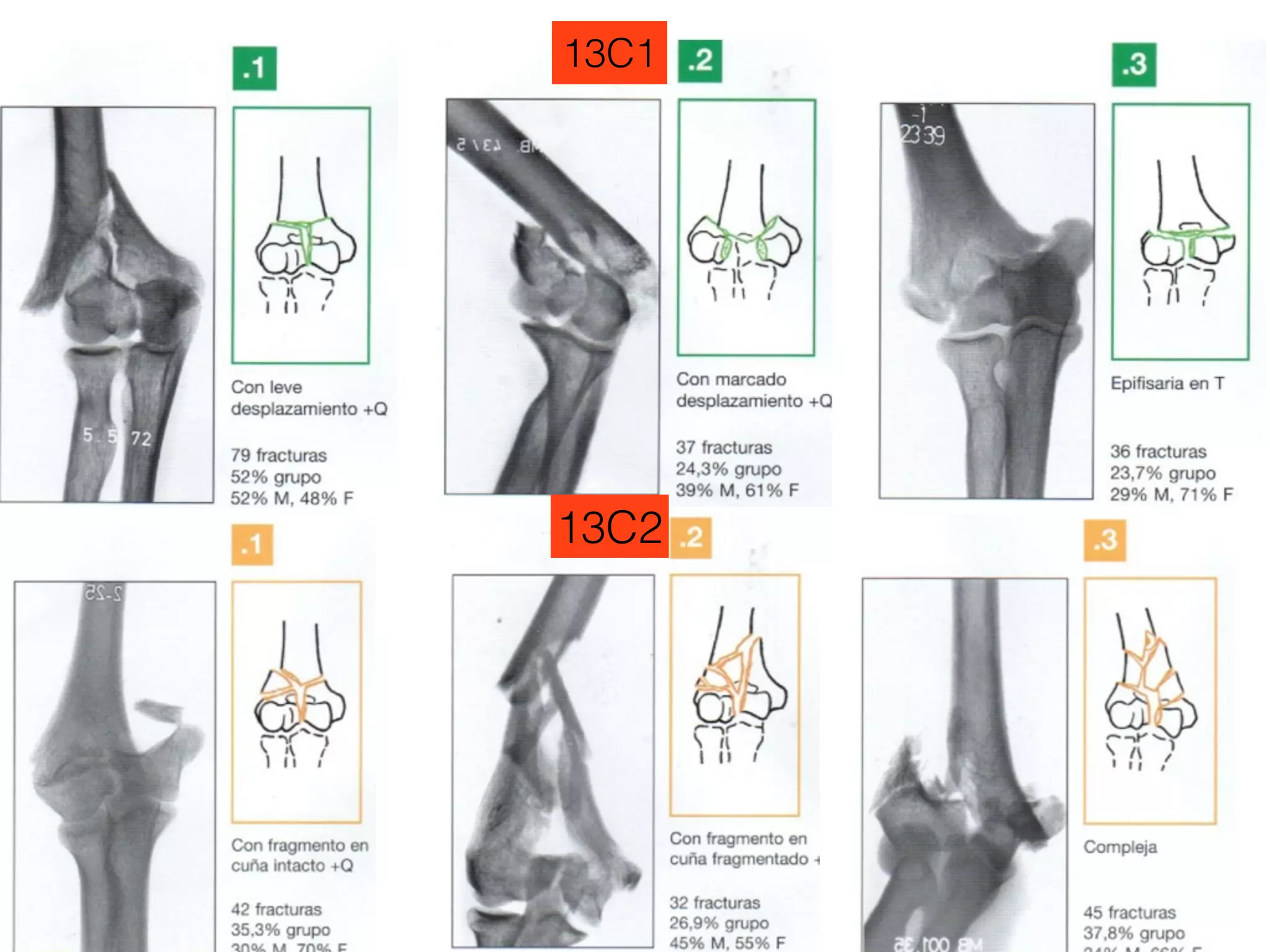 Fracturas de humero distal | PPT