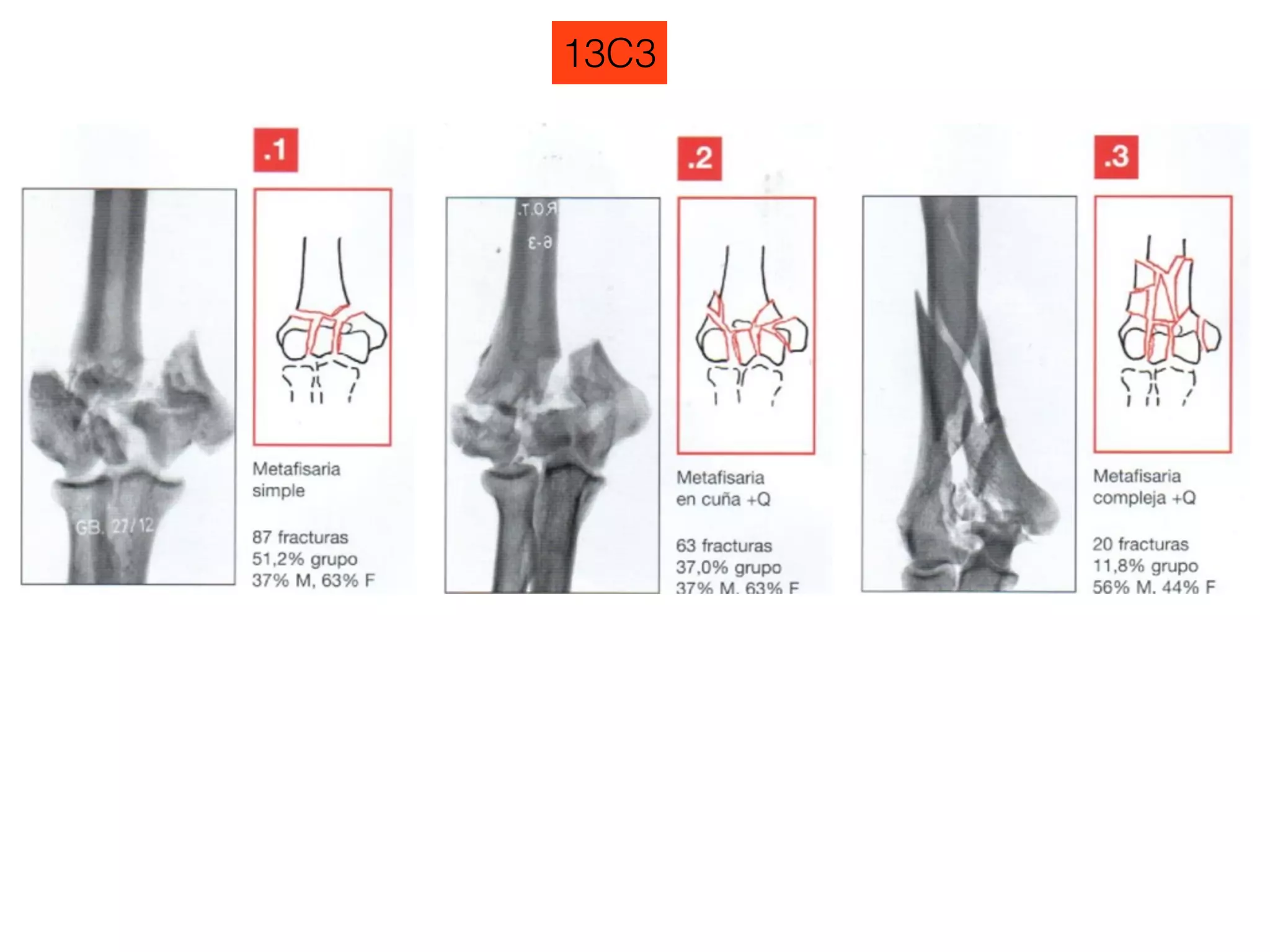 Fracturas de humero distal | PPT