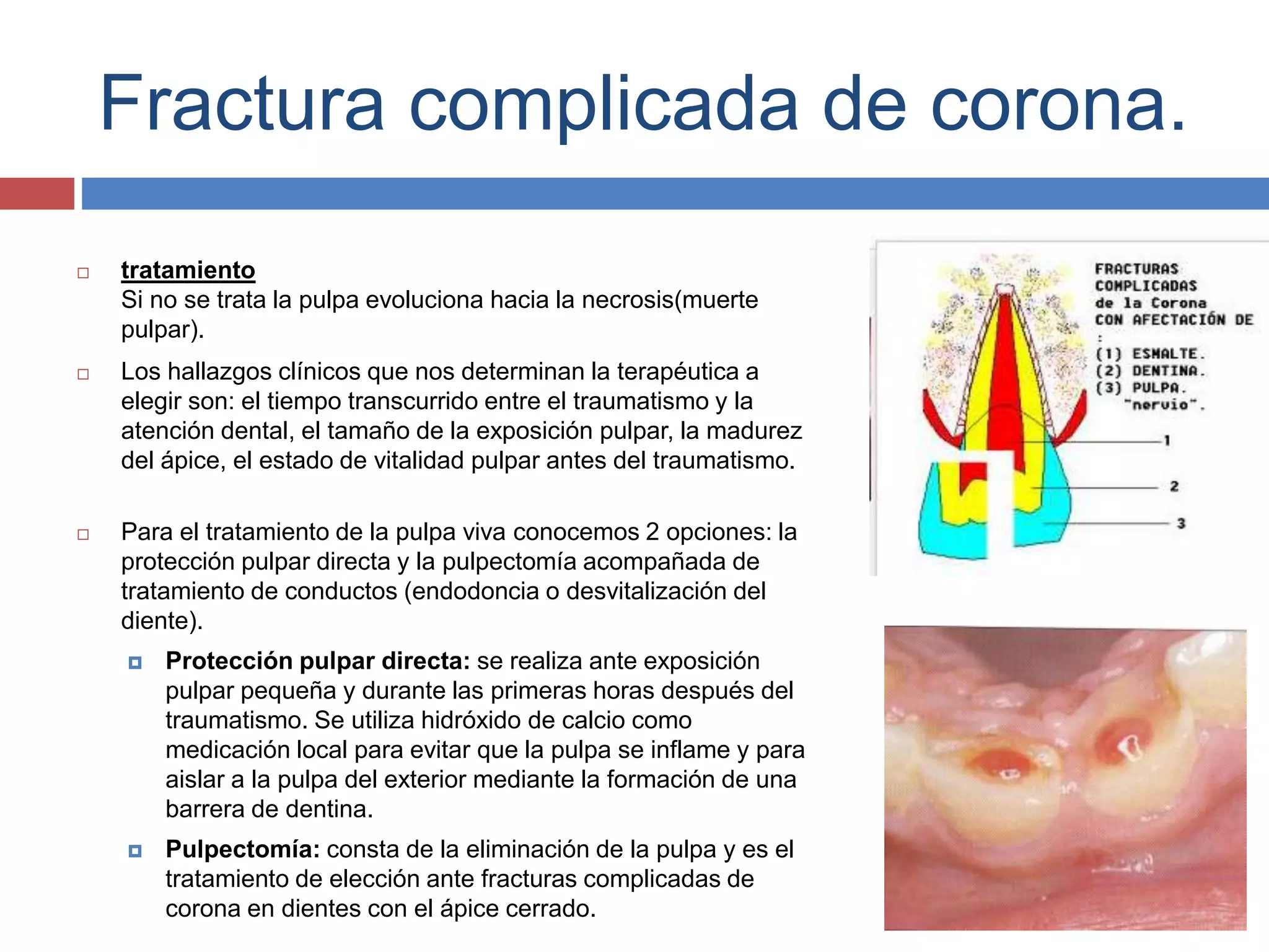 Fracturas de la corona | PPTX