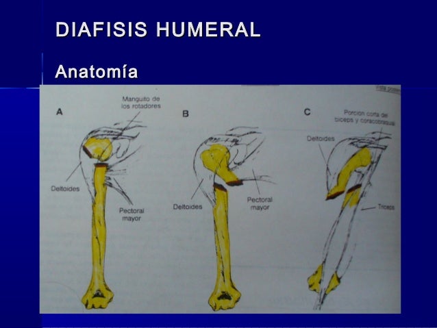 Fracturas de la diafisis humeral