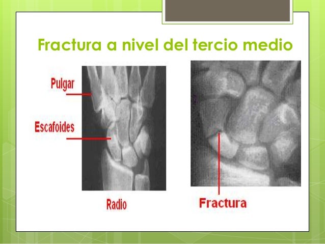 Fractura De Los Dedos De La Mano – EFHEC