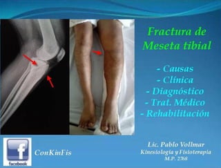 fracturas de la meseta o platillo tibial.PDF