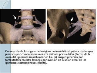 Fracturas del anillo pélvico | PPT