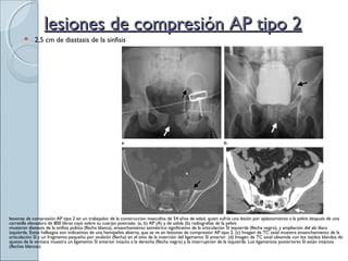 Fracturas del anillo pélvico | PPT