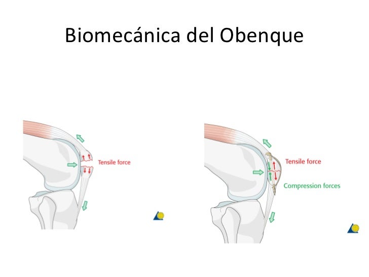 Fracturas de la rodilla