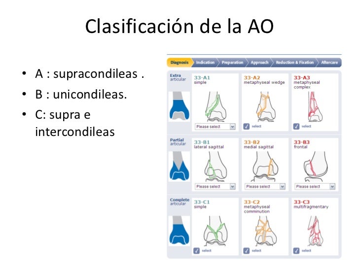 Fracturas de la rodilla