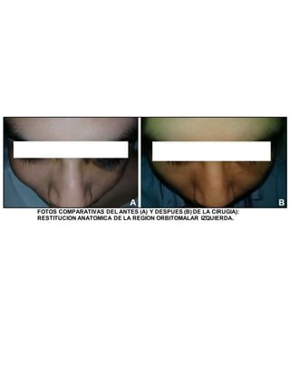 Fracturas del complejo orbitomalar | DOCX