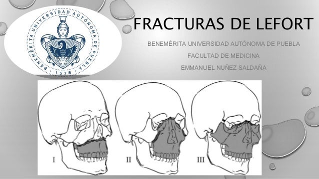 Fracturas de Lefort