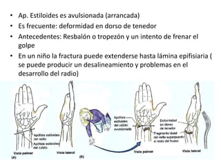Fracturas del húmero | PPTX