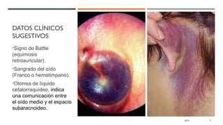Fracturas del hueso temporal y lesiones sobre oído.pptx