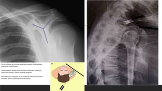FRACTURAS DEL HUMERO PROXIMAL.pptx