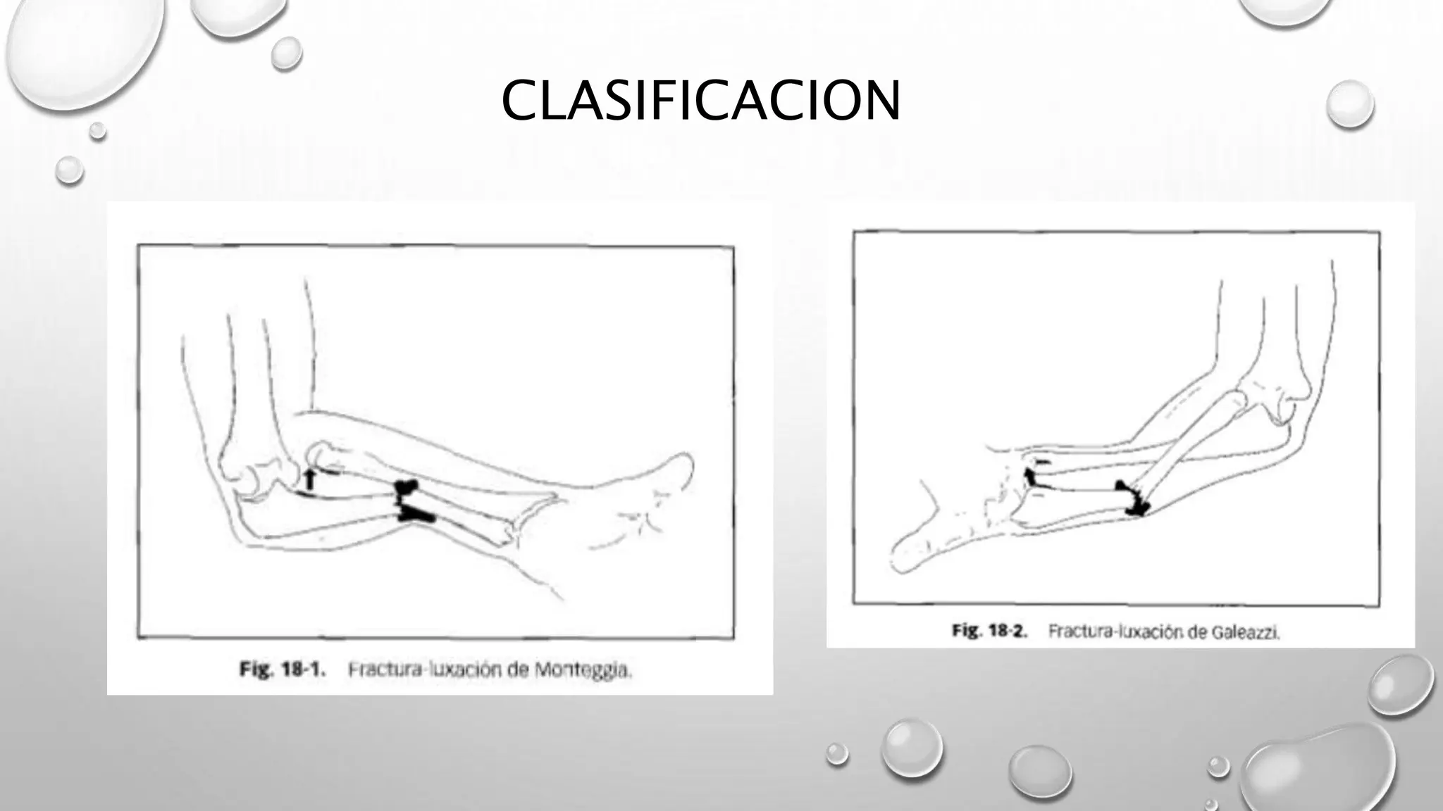 FRACTURAS DEL OLECRANO [Autoguardado].pptx