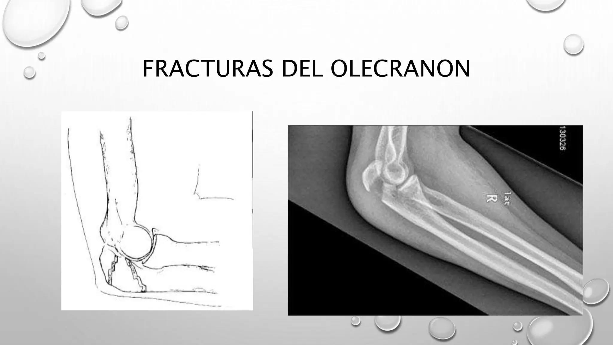 FRACTURAS DEL OLECRANO [Autoguardado].pptx