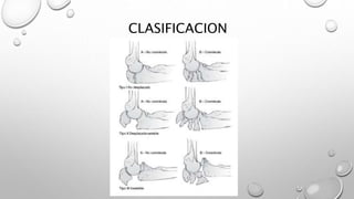 FRACTURAS DEL OLECRANO [Autoguardado].pptx