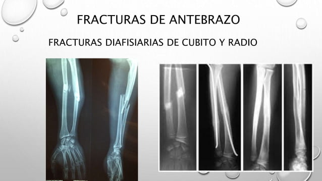FRACTURAS DEL OLECRANO [Autoguardado].pptx