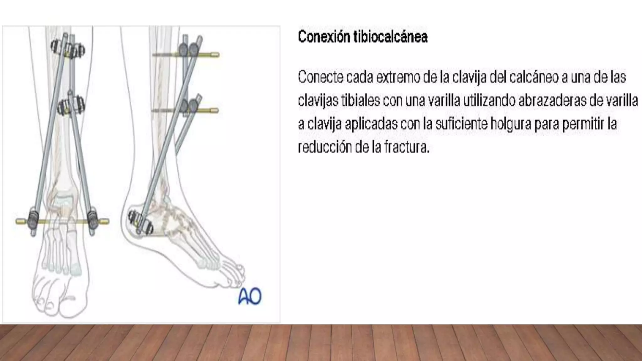 FRACTURAS DEL PILON TIBIAL.pptx