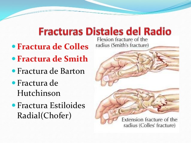 Fracturas del radio distal