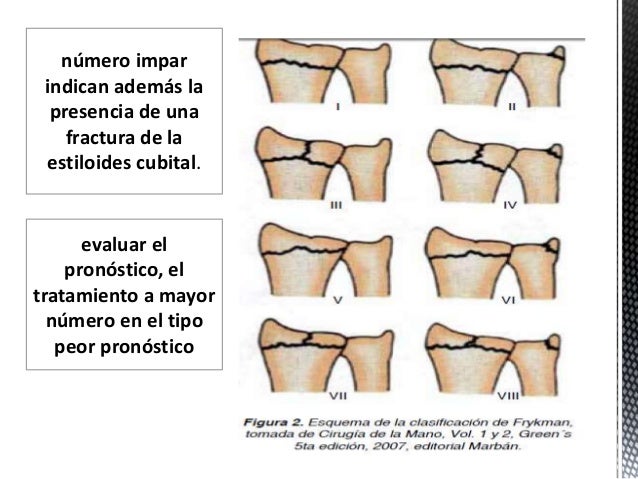 Fracturas del Radio distal