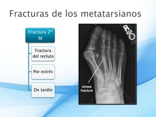 Fracturas del tarso, metatarso y dedos del pie | PPTX