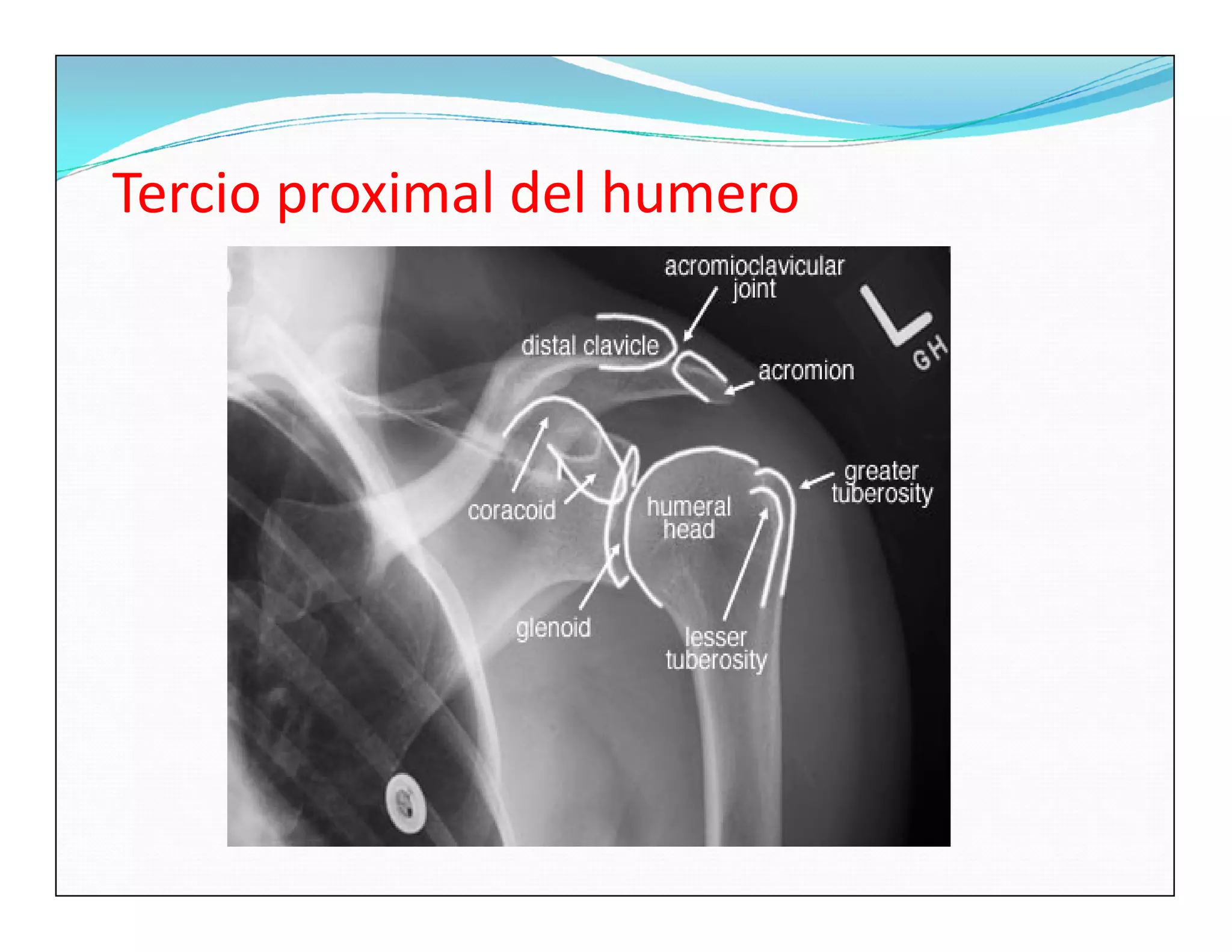 Fracturas del tercio proximal del humero | PDF