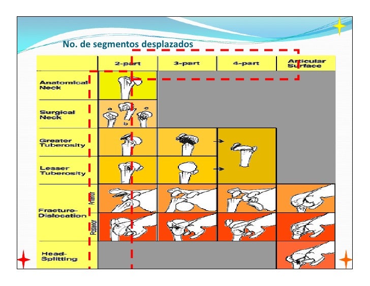 Fracturas del tercio proximal del humero