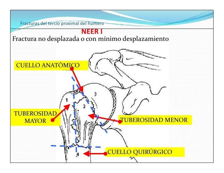Fracturas del tercio proximal del humero