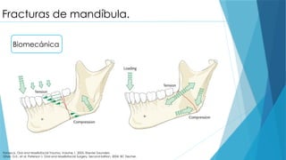 Fracturas de mandíbula- manejo tto .pptx