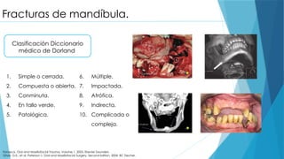 Fracturas de mandíbula- manejo tto .pptx