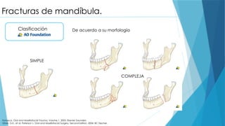 Fracturas de mandíbula- manejo tto .pptx