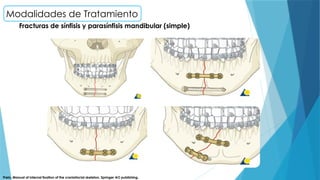 Fracturas de mandíbula- manejo tto .pptx
