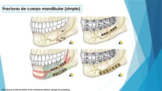 Fracturas de mandíbula- manejo tto .pptx