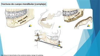 Fracturas de mandíbula- manejo tto .pptx
