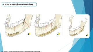 Fracturas de mandíbula- manejo tto .pptx