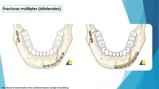 Fracturas de mandíbula- manejo tto .pptx
