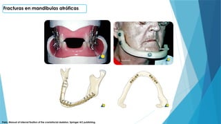 Fracturas de mandíbula- manejo tto .pptx