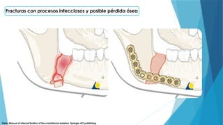 Fracturas de mandíbula- manejo tto .pptx