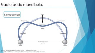 Fracturas de mandíbula- manejo tto .pptx