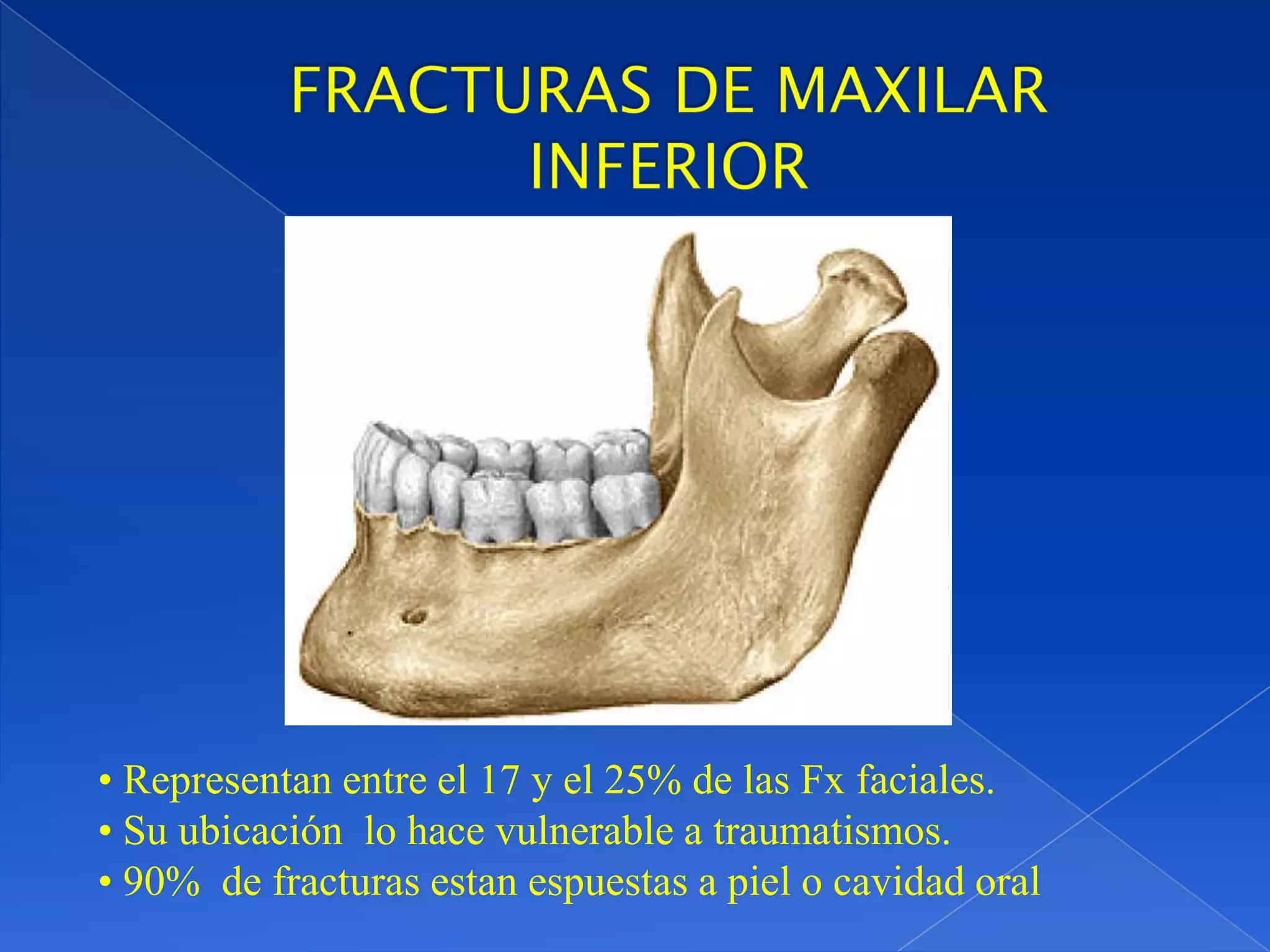 Fracturas de mandibula | PPT