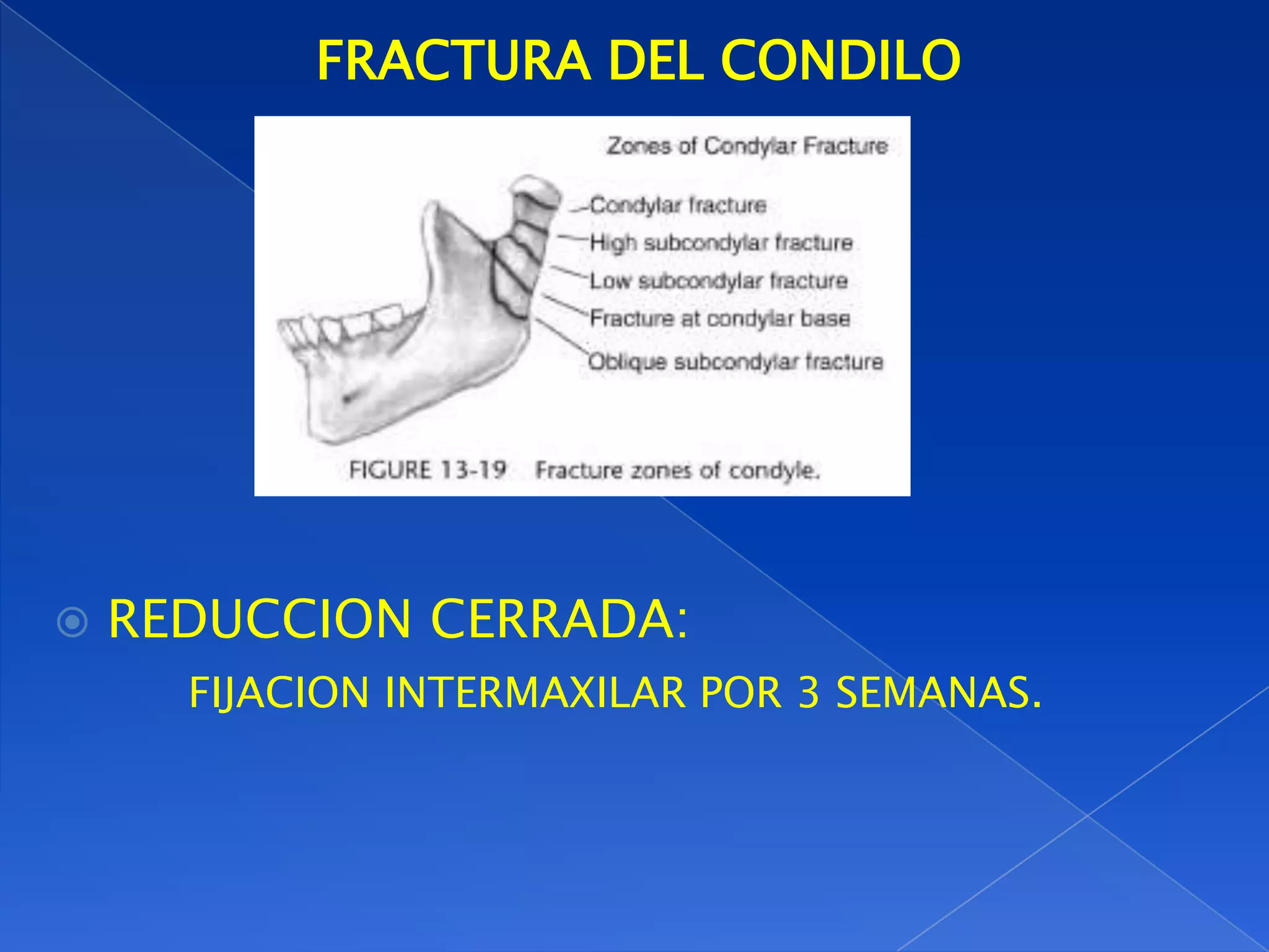 Fracturas de mandibula | PPTX