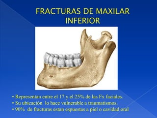 Fracturas de mandibula | PPTX