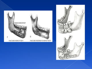 Fracturas de mandibula | PPTX