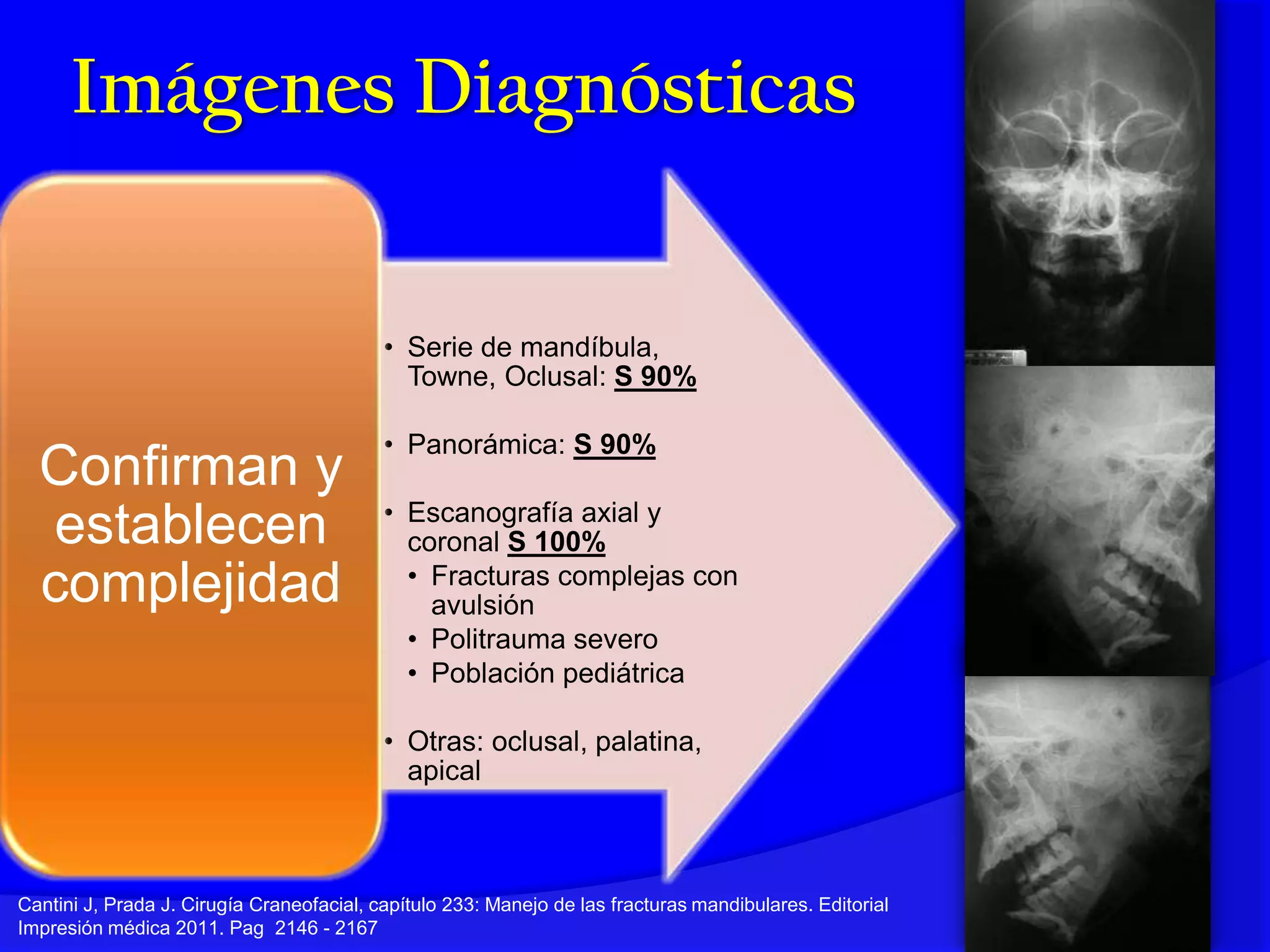 Fracturas de mandibula archivo definitivo | PPTX