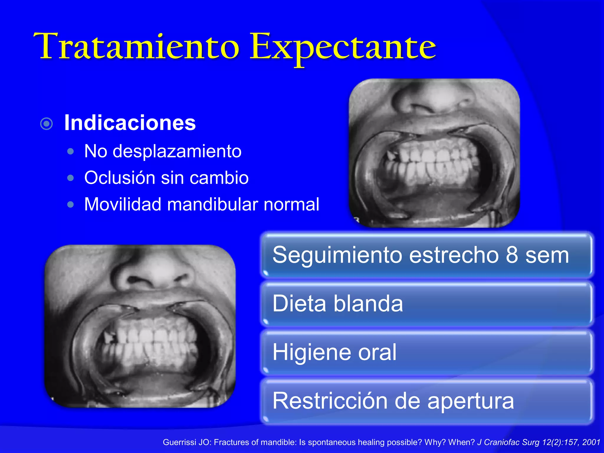 Fracturas de mandibula archivo definitivo | PPTX