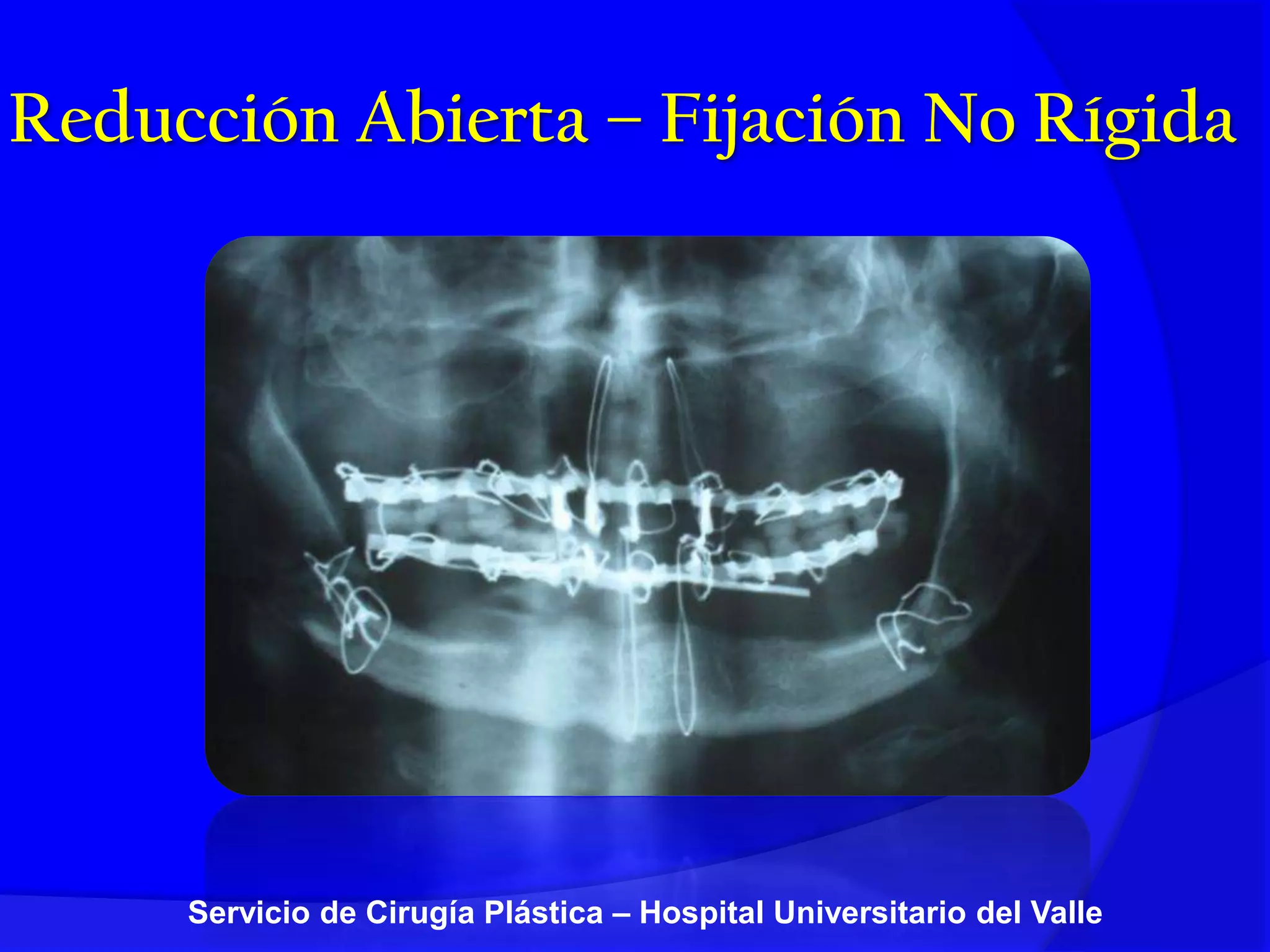 Fracturas de mandibula archivo definitivo | PPTX